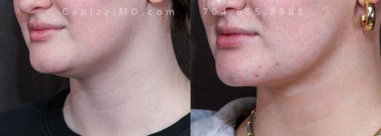Submental Liposuction | Capizzi MD
