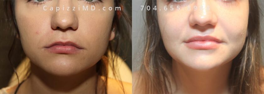 Filler | Capizzi MD